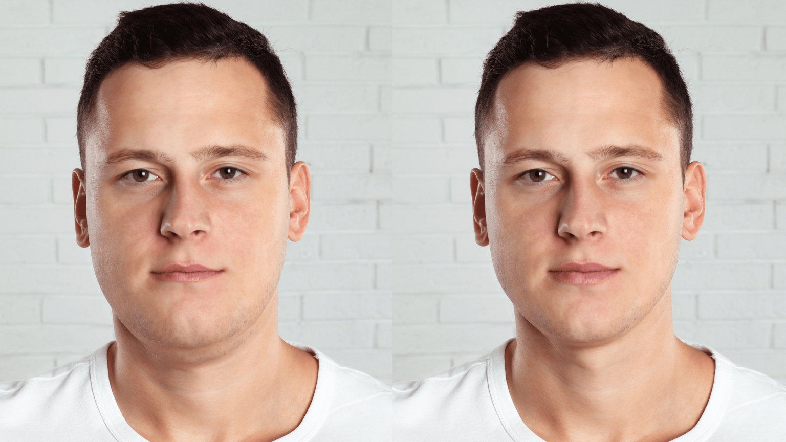 Say Goodbye to Your Double Chin: Causes and Treatments Revealed